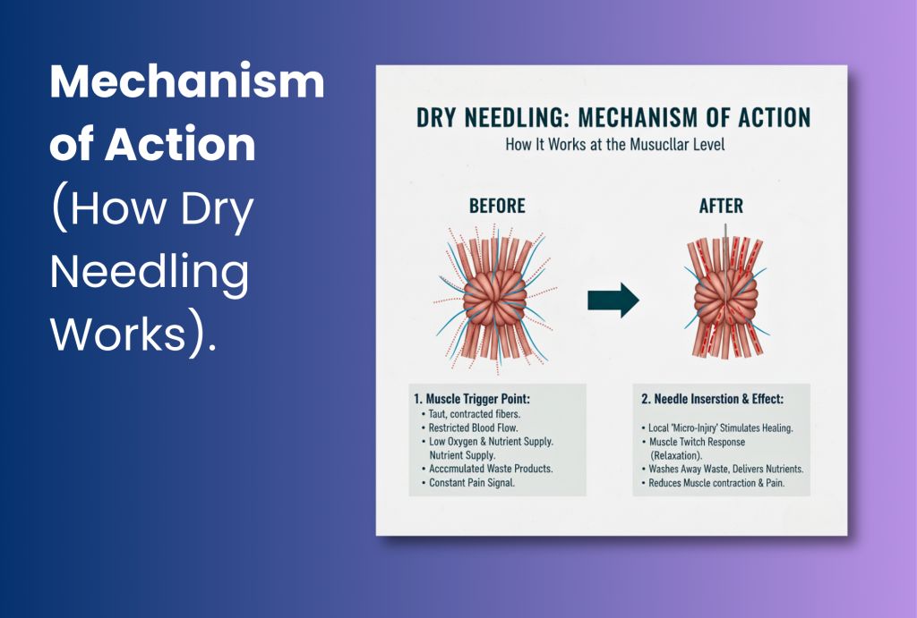 Relieve Muscle Pain Naturally with Dry Needling Therapy